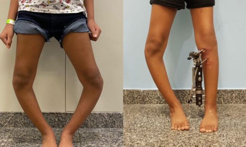 Técnica inovadora corrige deformidades nas pernas de crianças e jovens ...